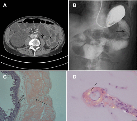 Curious case of gut dysmotility | Gut