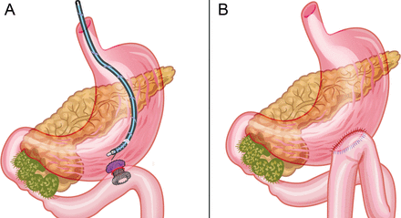 Endoscopic or surgical gastroenterostomy for malignant gastric outlet ...