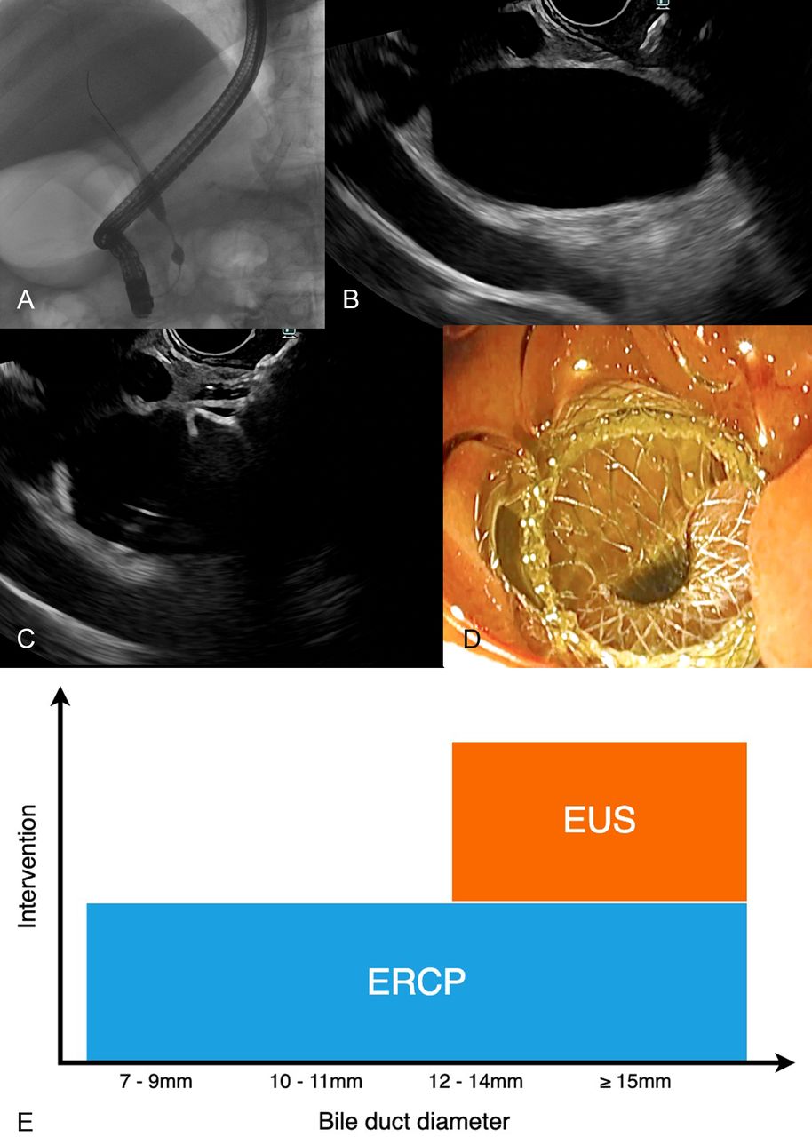Rate of suitable cases for primary EUS-guided biliary drainage in ...